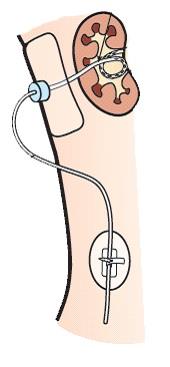 A Brief Guide to Nephrostomy | Shop Catheters